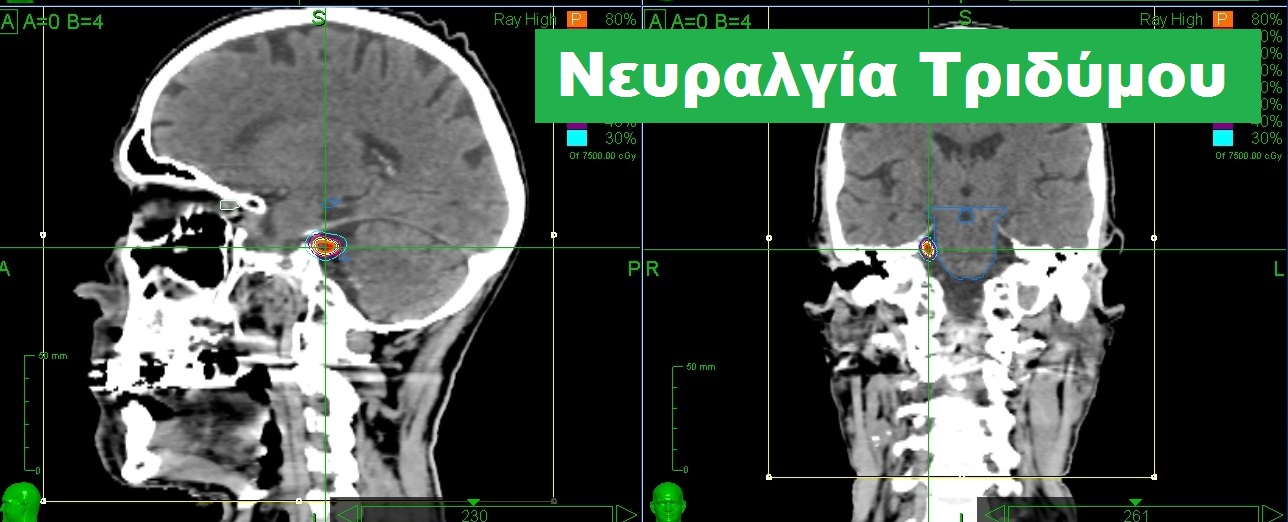 Νευραλγία Τριδύμου | Hellenic Stereotactic Radiosurgery Society