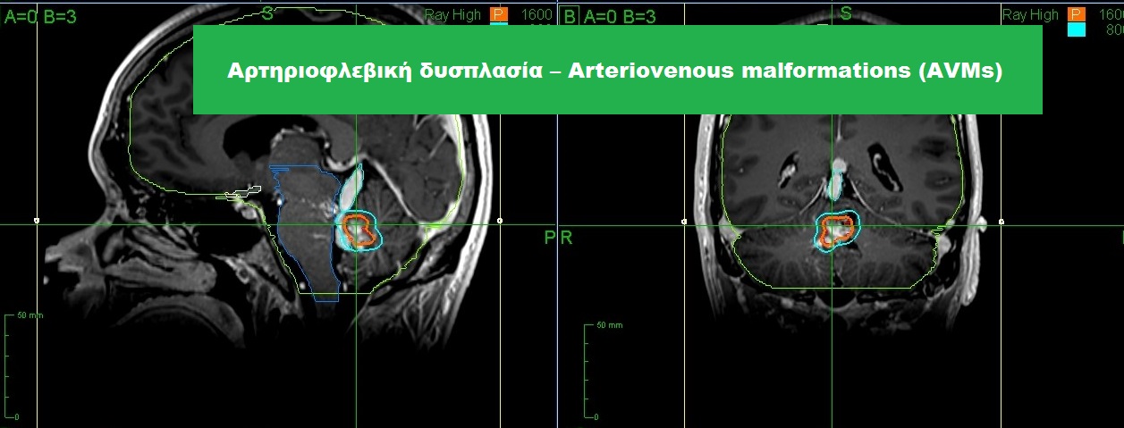 Αρτηριοφλεβλωδης δυσπλασία - Arteriovenous malformations (AVMs ...