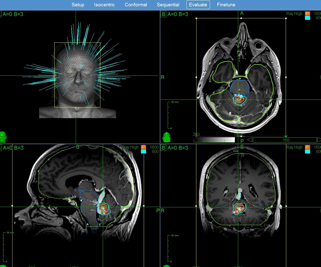 Αρτηριοφλεβλωδης δυσπλασία - Arteriovenous malformations (AVMs ...